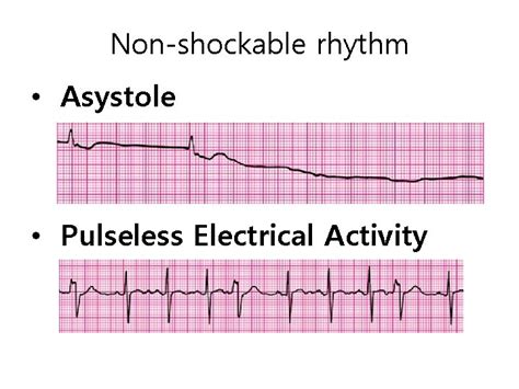 Shockable Vs Non Shockable Rhythms Aed Use Explained
