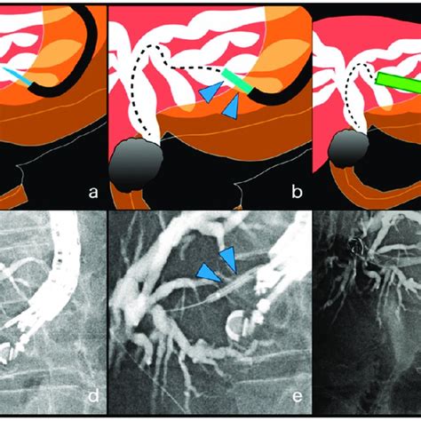 Procedure Process Of Endoscopic Ultrasound Guided Hepaticogastrostomy Download Scientific