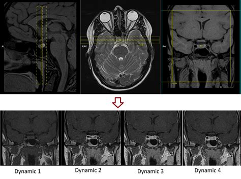 Pituitary Mri Protocols Planing And Indications Pituitary Dynamic