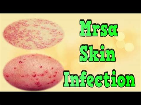Mrsa Skin Infection What Mrsa How To Get Rid Of Mrsa What Are The