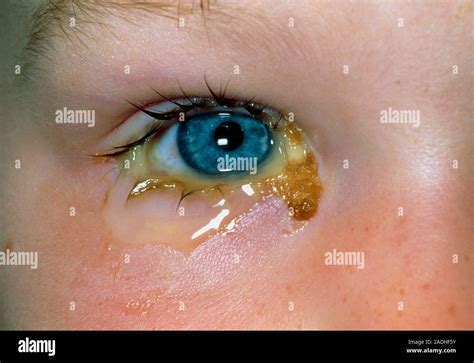 Bacterial Conjunctivitis Discharge From The Eye Of A 3 Year Old Girl