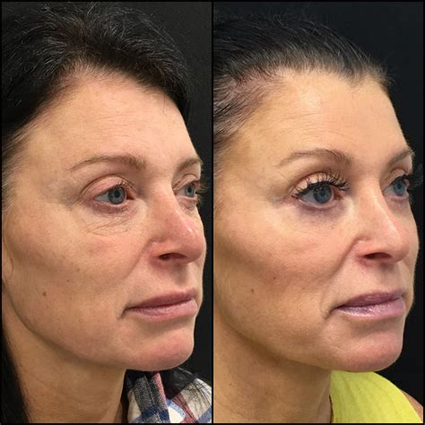 Lower Blepharoplasty Before And After Photos Flora Levin Md