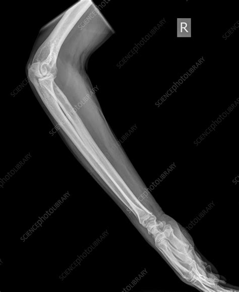Distal Radius Fracture X Ray Stock Image C056 4173 Science Photo Library