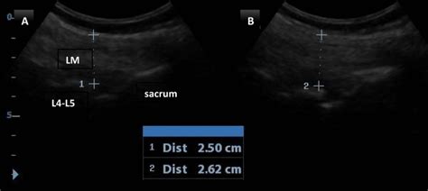 Contraction Ratio Of Multifidus And Erector Spinae Muscles In