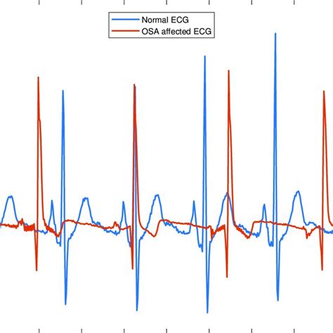 Pdf Diagnosis Of Obstructive Sleep Apnea From Ecg Signals Using Machine Learning And Deep