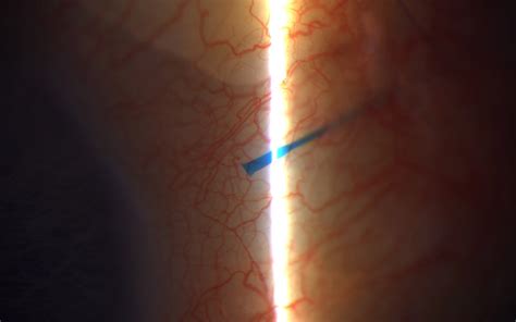 Paul­® Glaucoma Implant Dr Paul Chew