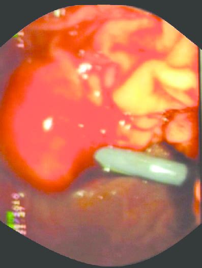 Photograph Of The Ercp Showing A Stent Placed In The Bulging Ampulla
