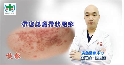 帶您認識帶狀皰疹 澳門捷報一專注大灣區「三創」資訊
