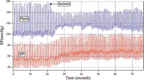 Response Of The Pulse Oximeter Waveform Pleth To Surgical