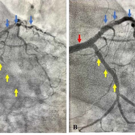 Coronary Perfusion Scan Before And After Revascularization A Coronary Download Scientific