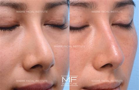 4 Ways To Make Your Nose Appear Smaller With Filler Mabrie Facial