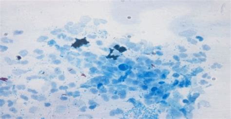 Showing Tubercle Bacilli As Bright Red In The Blue Background In