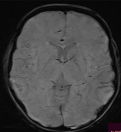 No Diffusion Restriction Was Seen In These Regions Download Scientific Diagram