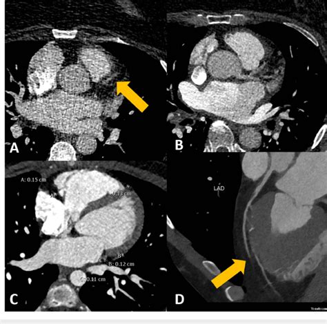Ccta Images Demonstrating Cardiac Motion Respiratory Motion And Poor