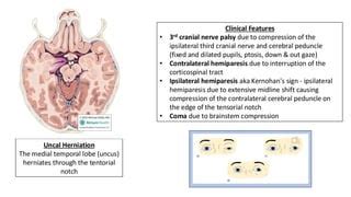 Herniation Syndromes Neuro Imaging Master Series Pdf