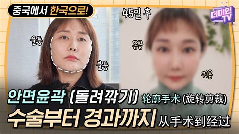 안면윤곽 돌려깎기 상담부터 수술 후 한달 경과까지 리얼 Vlog│轮廓手术 旋转剪裁 从手术到经过 现在检查一下。 Youtube