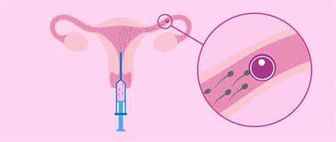 What Is Artificial Insemination