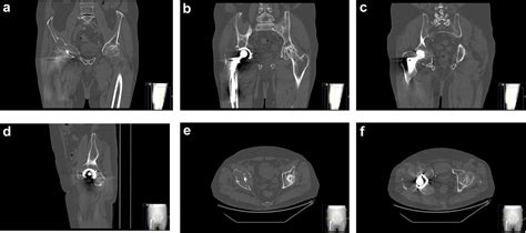 Massive Periacetabular Osteolysis Treated With Acetabular Cup Retention And Cemented Screw