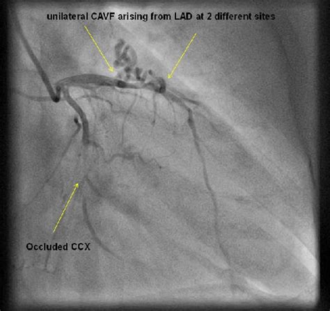 Patient 5 Unilateral Cavf Arising From Lad At 2 Different Site Download Scientific Diagram