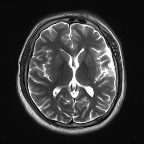 Temporal Lobe Atrophy Radiology Case Radiology Progressive Multifocal