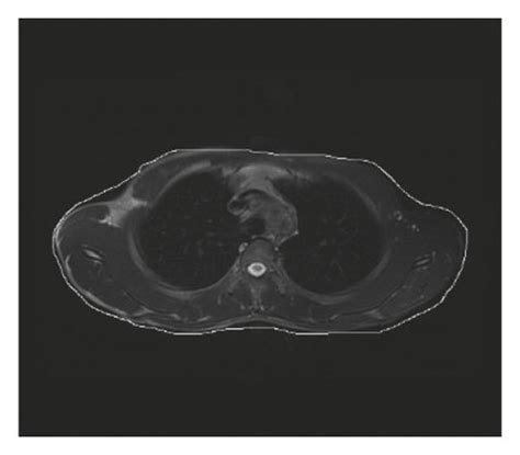 Comparison Of Lung Tissue Boundary Segmentation A Primitive Lung