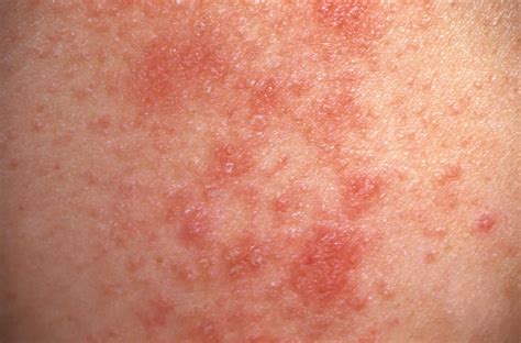 Skin Rash From Ecg Electrodes At Zane Stirling Blog