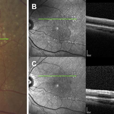 Clinicopathologic Correlation Of Nonexudative Type 1 Macular