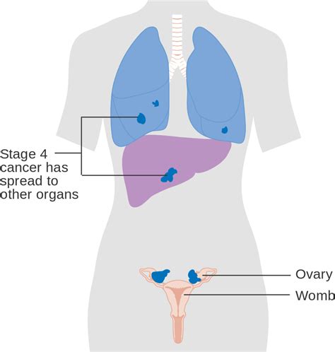 Download Stage4 Cancer Spread Illustration