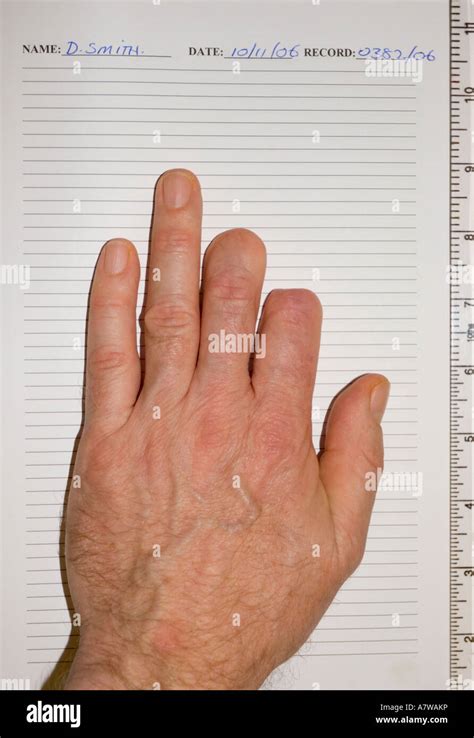 Thumb Amputation Injury
