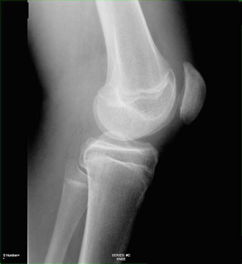 Xray Of Broken Knee