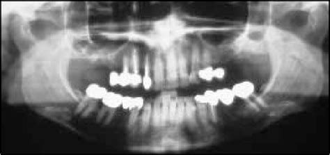 Figure 1 From Maxillary Sinus Augmentation With The Xenograft Bio Oss And Autogenous Intraoral