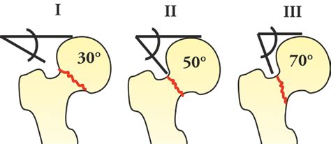 Pauwels Classification Wikilectures
