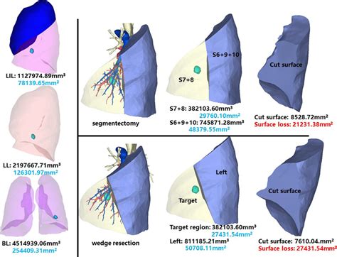 Segmentectomy Or Wedge Resection Of Ls7 8 Download Scientific Diagram