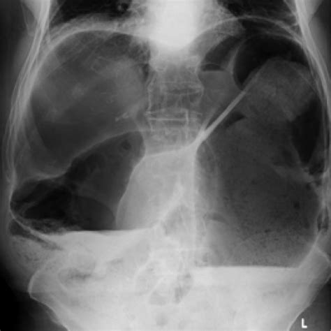 Lower Abdominal Midline Laparotomy Revealed Sigmoid Colon Was Extremity Download Scientific