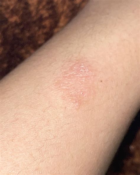 Is This Ezcema Ive Never Gotten It Before R Dermatologyquestions