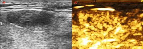 An Example Of Uniform Filling In The Left Frame B Mode The Lymph Node