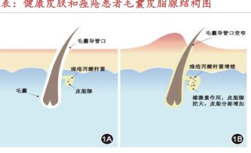 国内痤疮治疗市场规模弗若斯特沙利文测算 行业研究数据 小牛行研