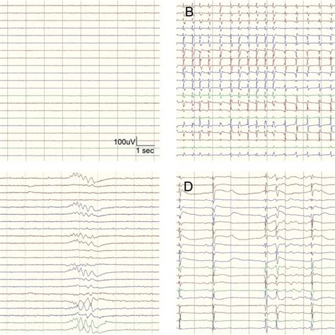 Highly Malignant Eeg Patterns Download Scientific Diagram