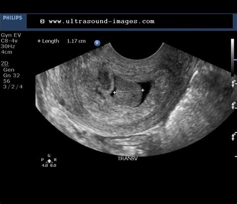 Cochinblogs Sonography In The Case Of Pedunculated Polyp
