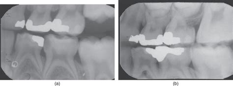 Ectopic Eruption Of Maxillary First Permanent Molar Pocket Dentistry