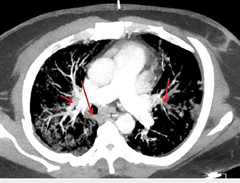 Ct Chest Angiography Showing Ground Glass Opacities And Bilateral Download Scientific Diagram