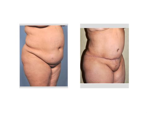 Safety Of Tummy Tuck Combined With Abdominal Liposuction Explore