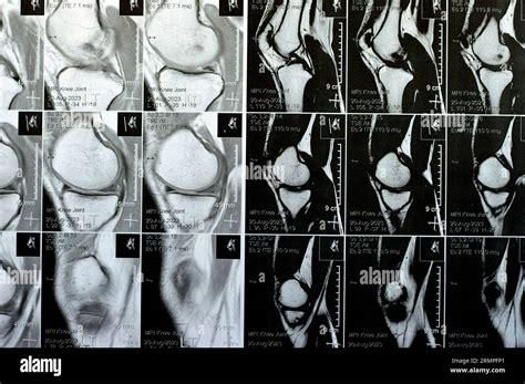 Mri Of Left Knee Joint Showing Minimal Joint Effusion Phmm Posterior Horn Medial Meniscus