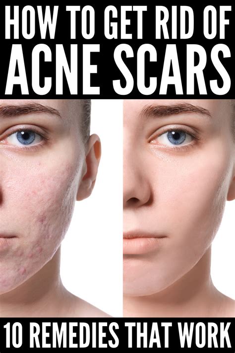 How To Get Rid Of Acne Scars Chin At Tamika Spear Blog