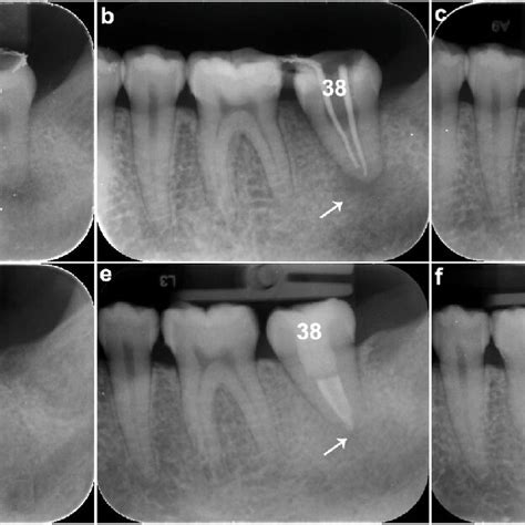 A Preoperative Intraoral Images Showing Complete Dislocation Of Tooth Download Scientific