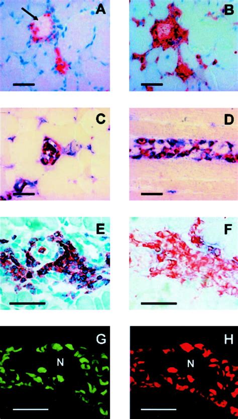 Expression Of Calcium Binding Proteins Mrp8 And Mrp14 In Inflammatory