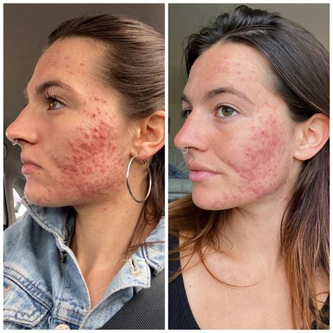 these pics are 15 days apart skin is finally starting to heal r acne