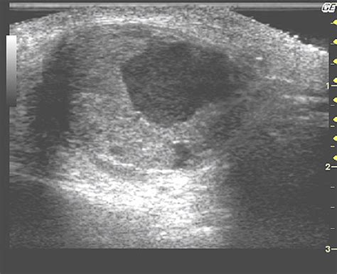 Parotid Gland Tumor Ultrasound