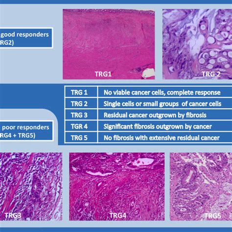 Mandard Tumor Regression Grade System Representative Examples