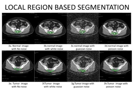 Ct Tumor Detection Using Local Region Based Segmentation Download